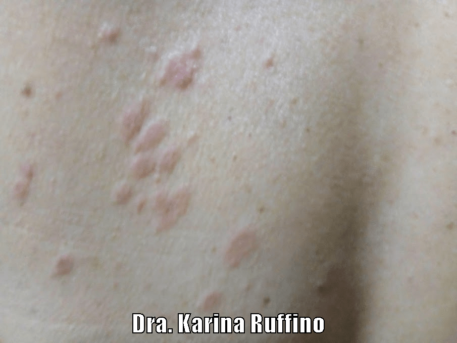 Pitiriasis Rosada de Gilbert: Una erupcion benigna de la piel. – Sobre ...